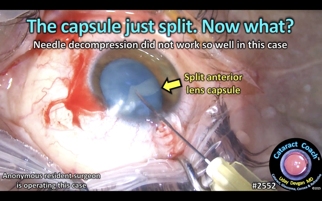 the capsule just split. now what? Argentinian flag sign white cataract